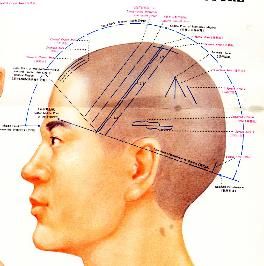 Scalp Acupuncture – Acupuncture Torbay – 01803 525019
